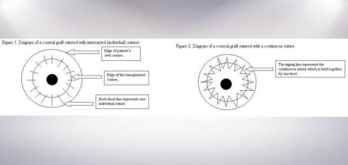 Corneal Transplant | Sarvodaya Eyecare Experts